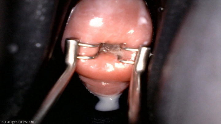 Strangecares Cervix Stretch W Endocervical Speculum Manyvids