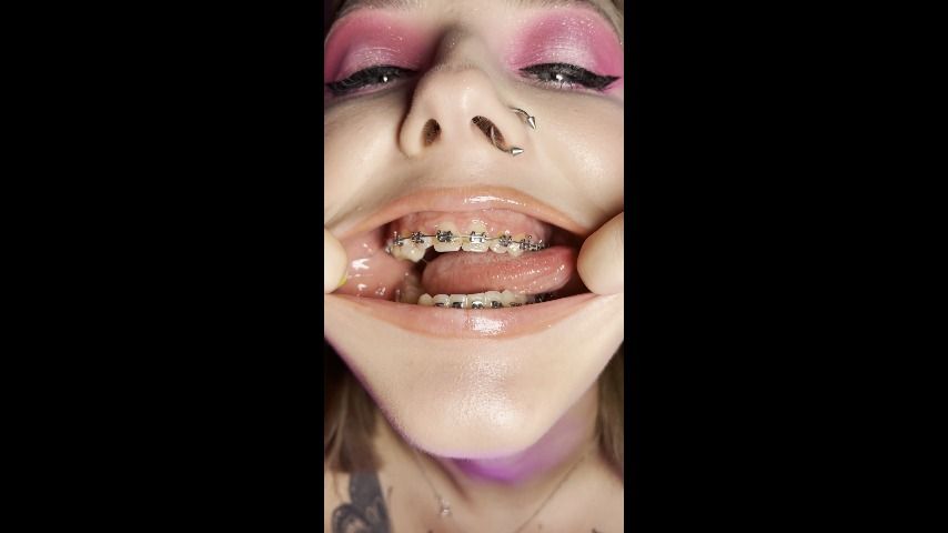Braces Fetish Pink Uvula And Metal Mouth Manyvids